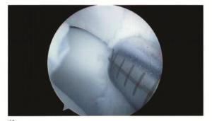 Snapping Elbow Plica Diagnose Treat Surgery Inlamed Elbow Houston TX