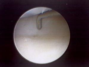 Triangular Fibrocartilage Tear TFC Surgery Orthopedic Wrist Surgeon ...